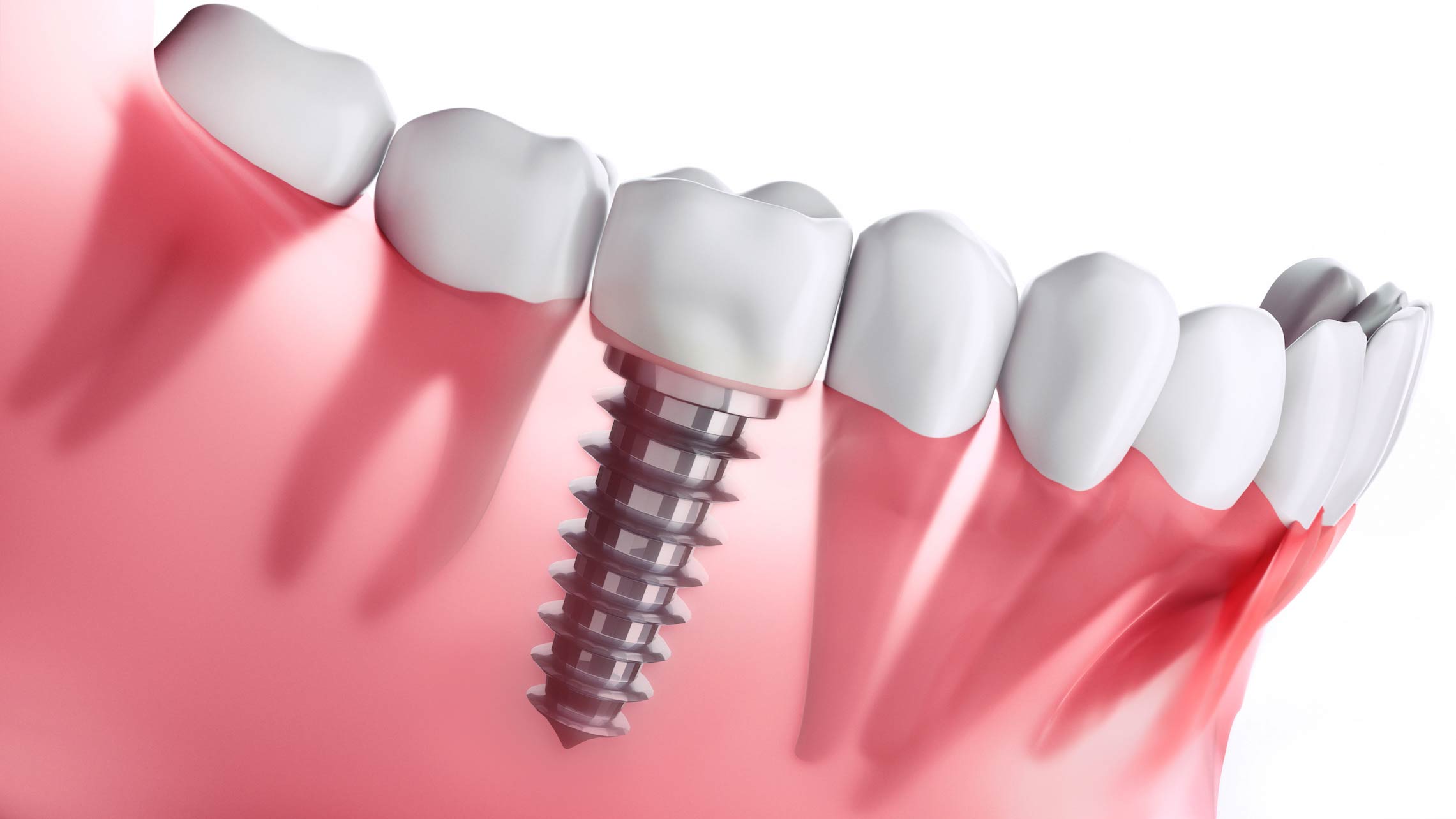 Um Guia Completo sobre Implantes Dentários - Instituto Paula Machado